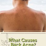 7 Ways to Treat and Prevent Your Back Acne
